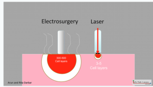 Laser-Tissue Interaction | GOLDMAN DENTAL MANAGEMENT