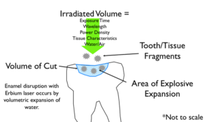 Hard Tissue Erbium Laser Model | GOLDMAN DENTAL MANAGEMENT