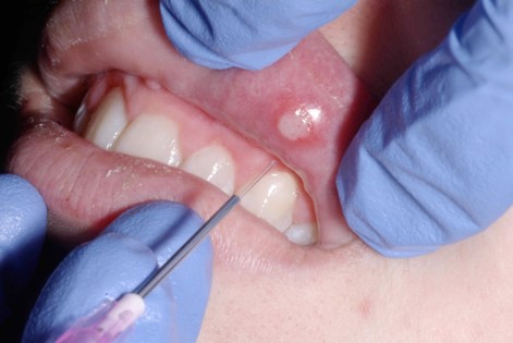 Aphthous Ulcer | GOLDMAN DENTAL MANAGEMENT