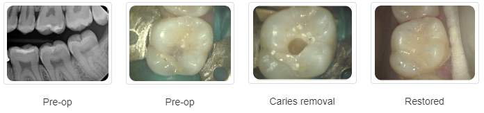 Class 1 Preparation | GOLDMAN DENTAL MANAGEMENT
