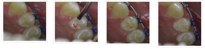 Class 1 Restoration | GOLDMAN DENTAL MANAGEMENT