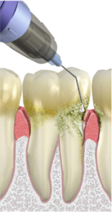 Oraqix Application | GOLDMAN DENTAL MANAGEMENT