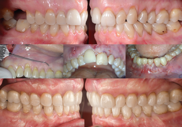 Oral Plastic Surgery For Soft Tissue Augmentation Around Teeth ...